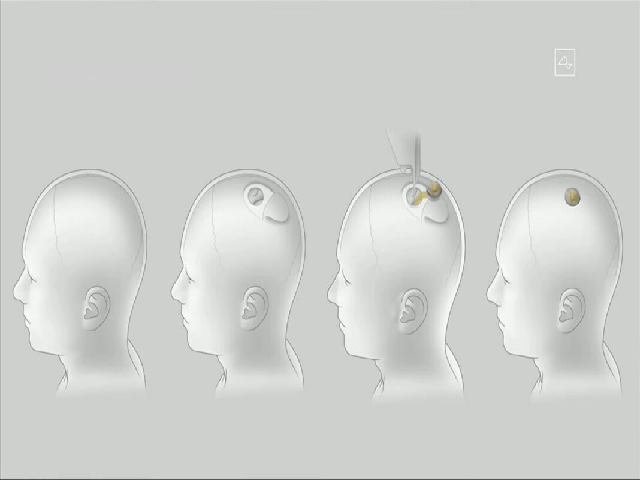 What is Neuralink? All about Elon Musk's new technology and it's uses
