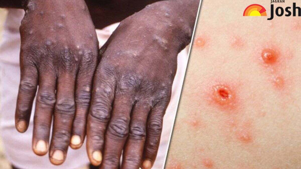 How is it difference between monkeypox and chickenpox?